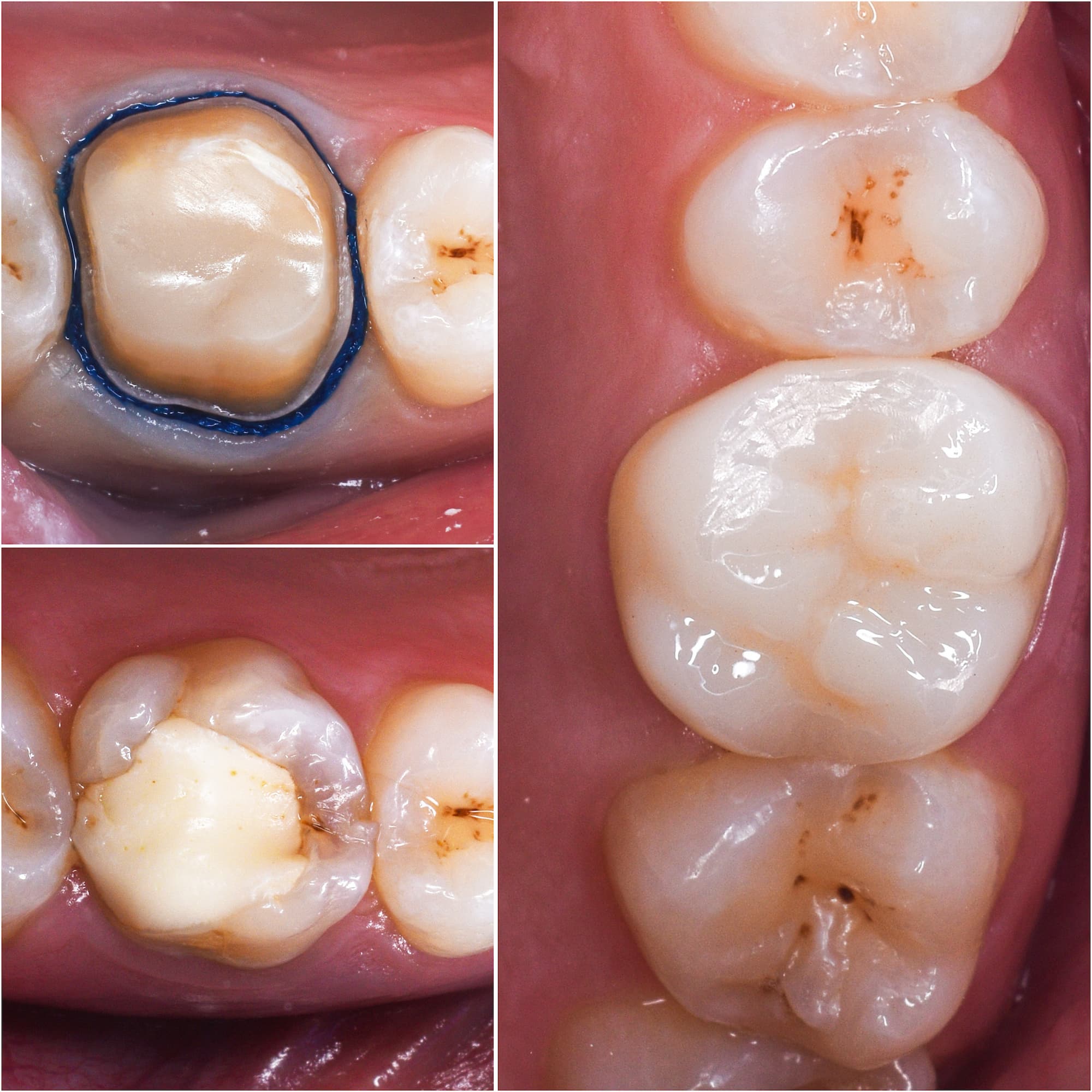 Dental Fillings | Newport Family Dentist